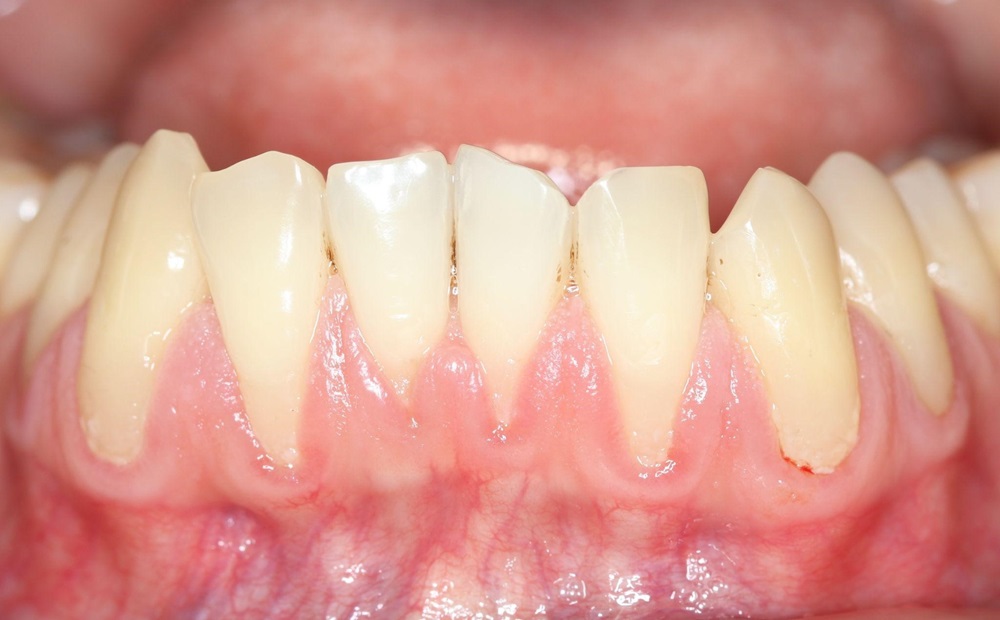 How to Prevent Gum Recession - Tips and Techniques for a Healthy Smile ...